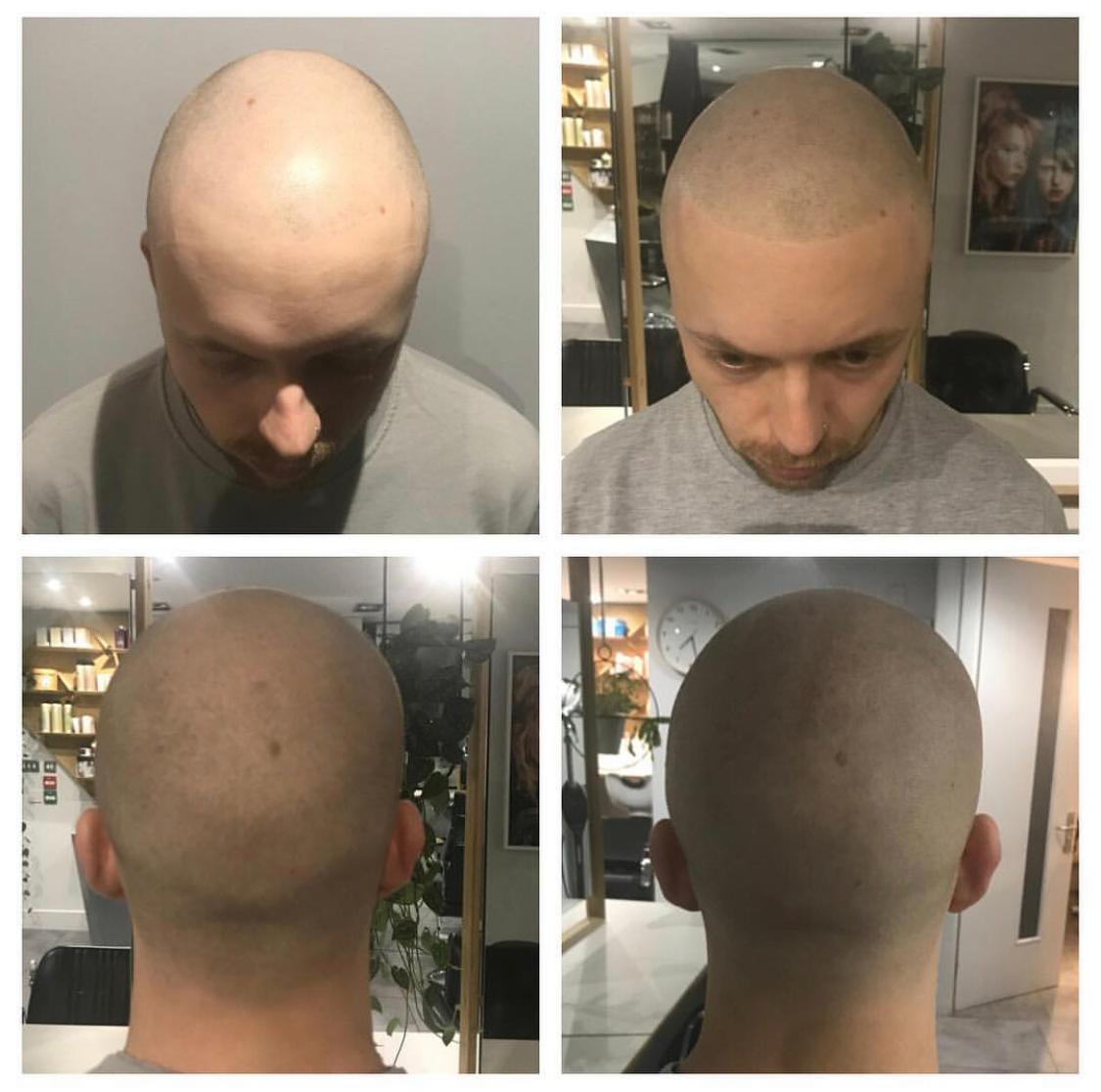 Scalp Micropigmentation- How it works and is it right for you? | Gina ...